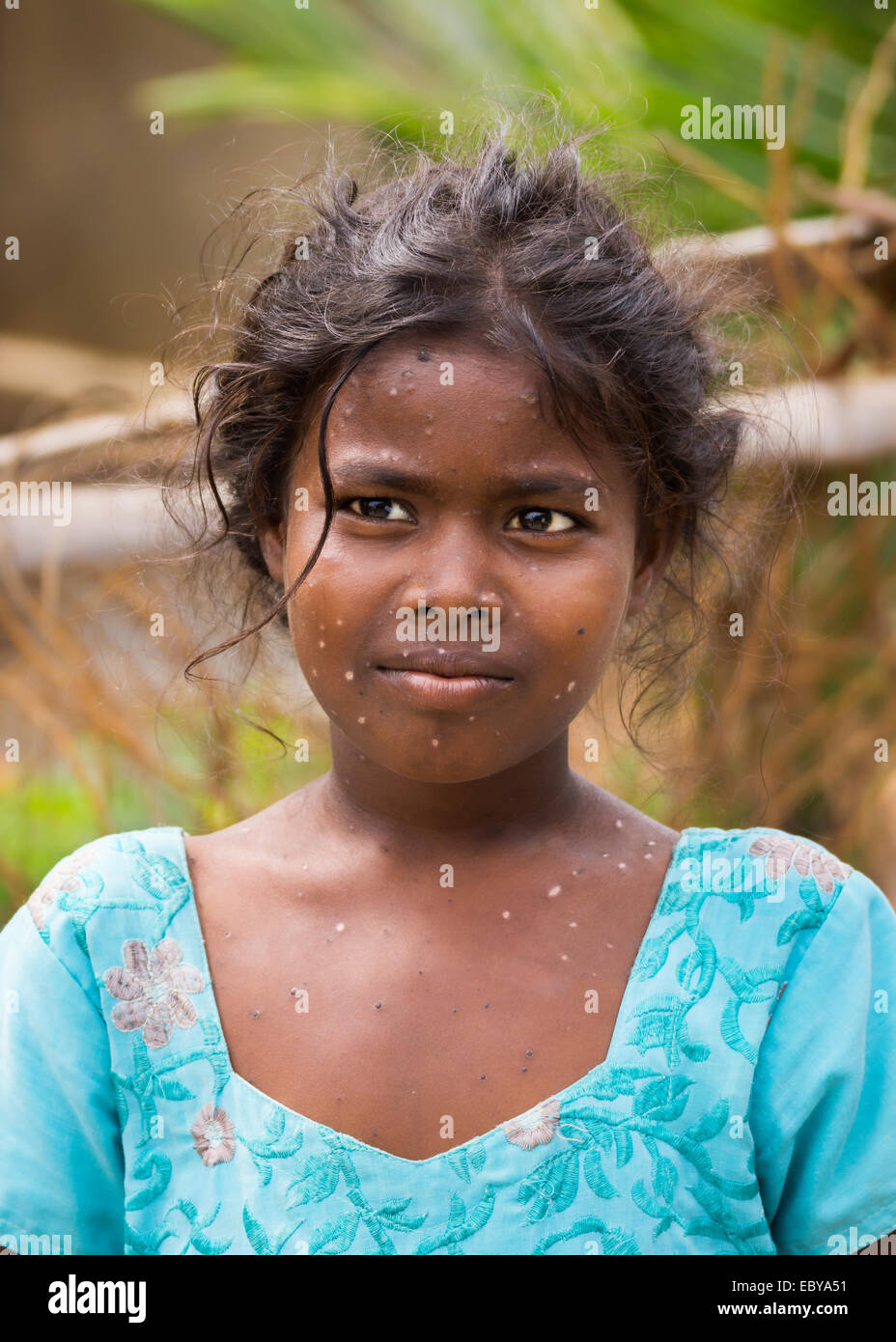 The face of chicken pox Stock Photo - Alamy
