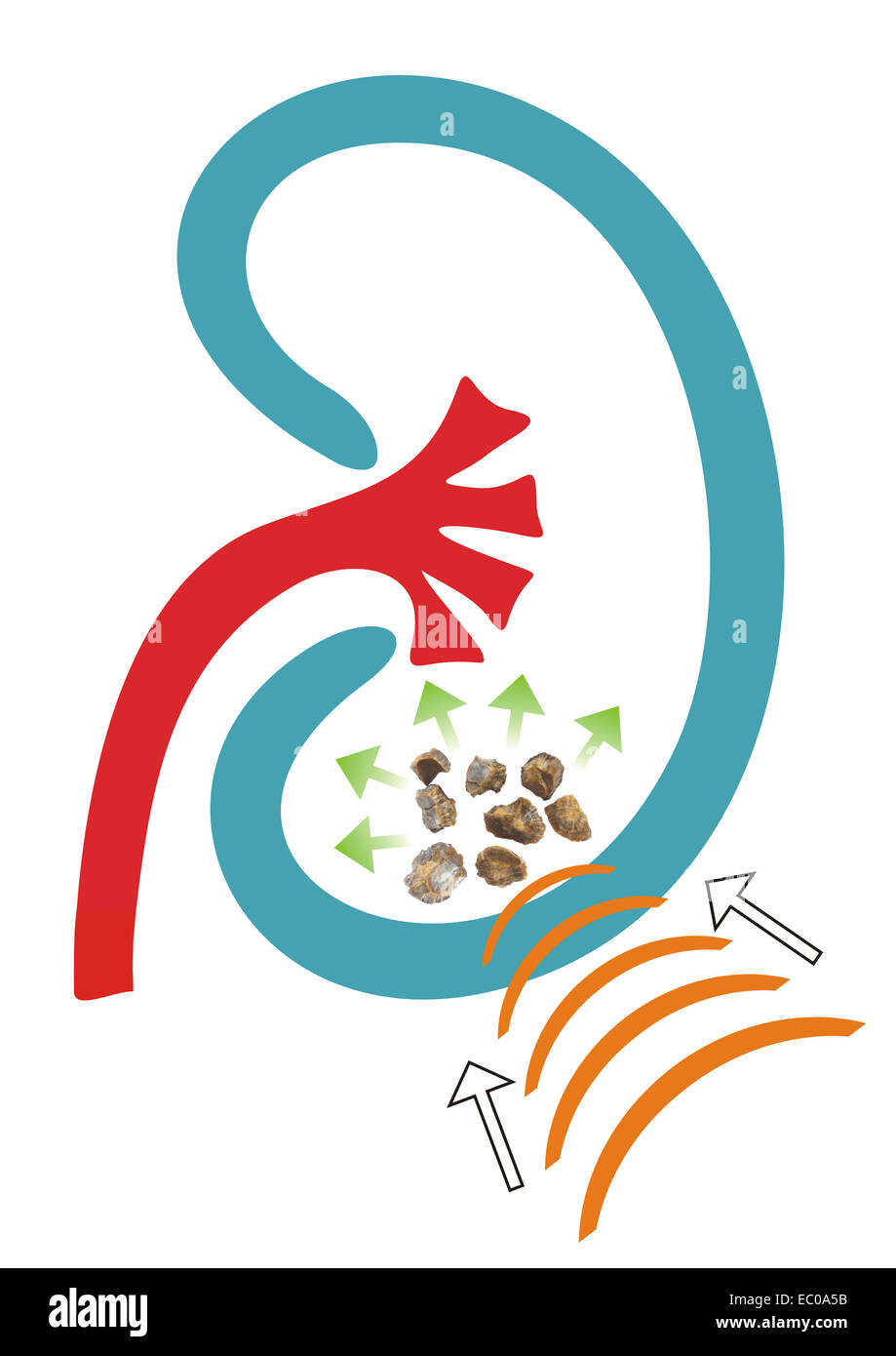 Kidney stone hi-res stock photography and images - Alamy