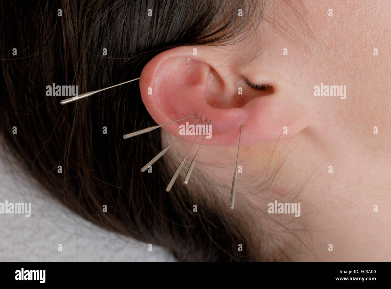 Acupuncture Needles in Ear Stock Photo - Alamy