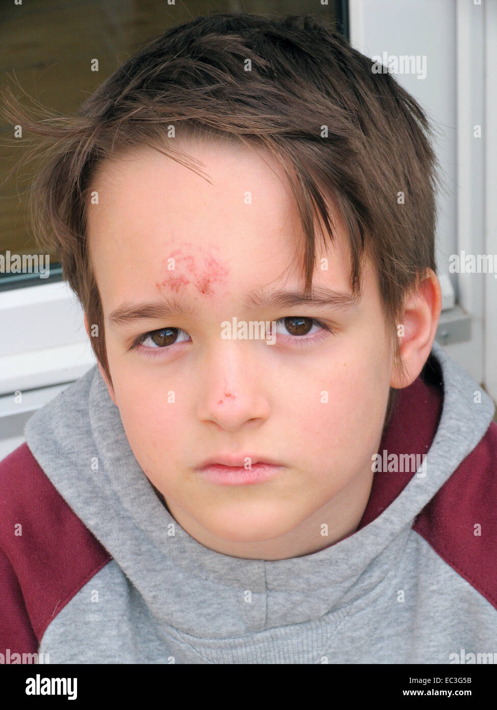 Boy with Injury at the Face Stock Photo - Alamy