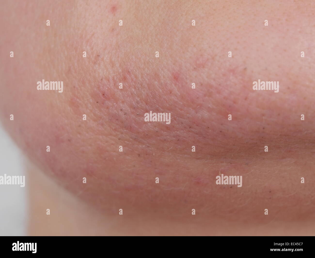 Close up of human skin, presenting an allergic reaction, allergic rash ...