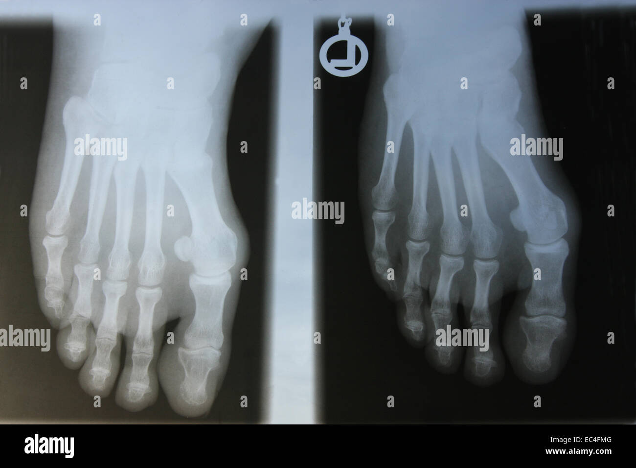 Hammer Toes Xray