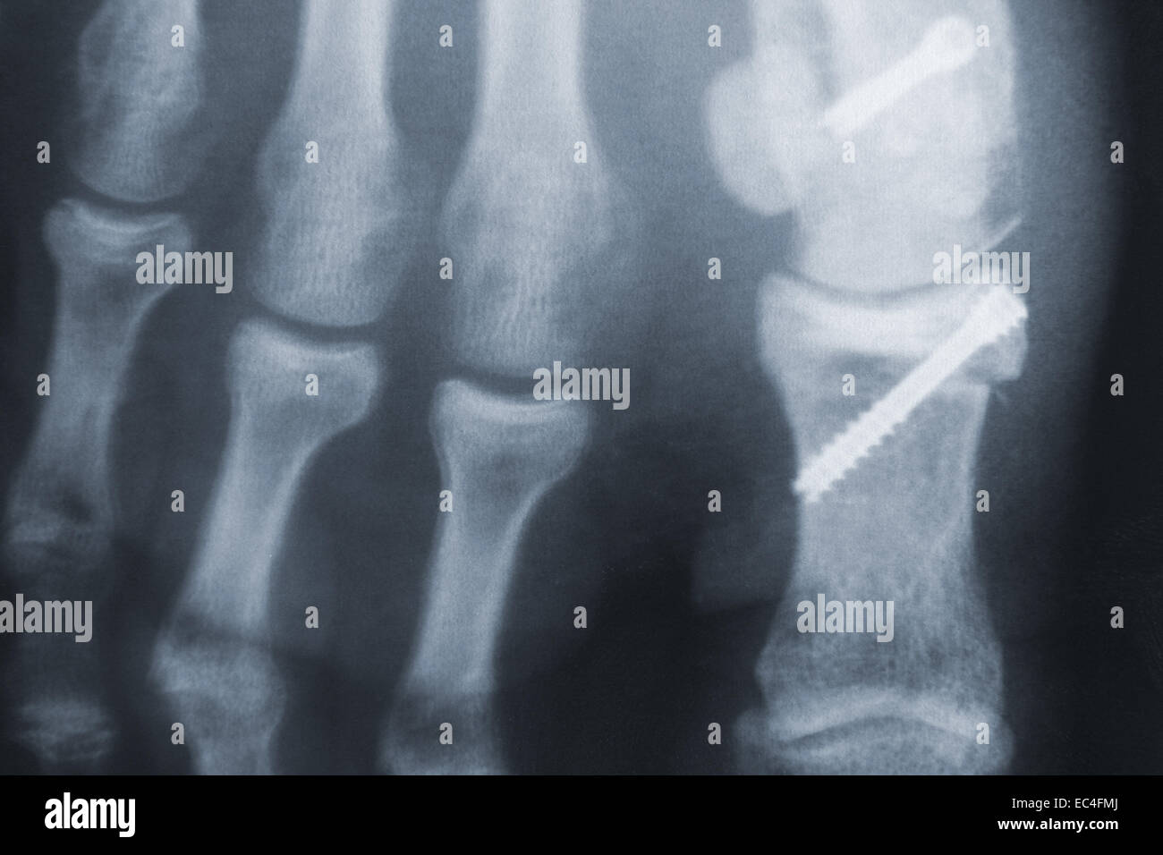 Hammer Toes Xray