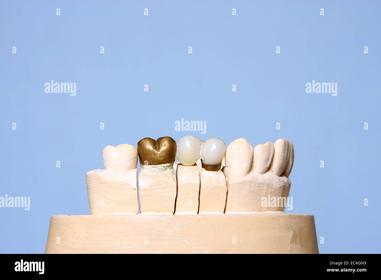 Gold crown tooth hi-res stock photography and images - Alamy
