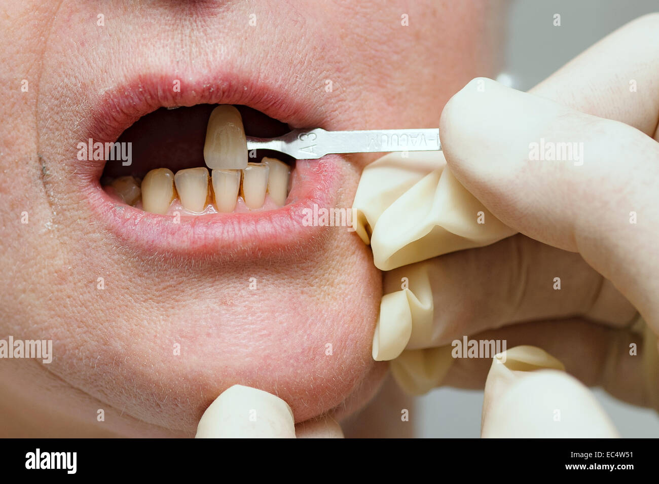 Color match the teeth of a patient Stock Photo - Alamy