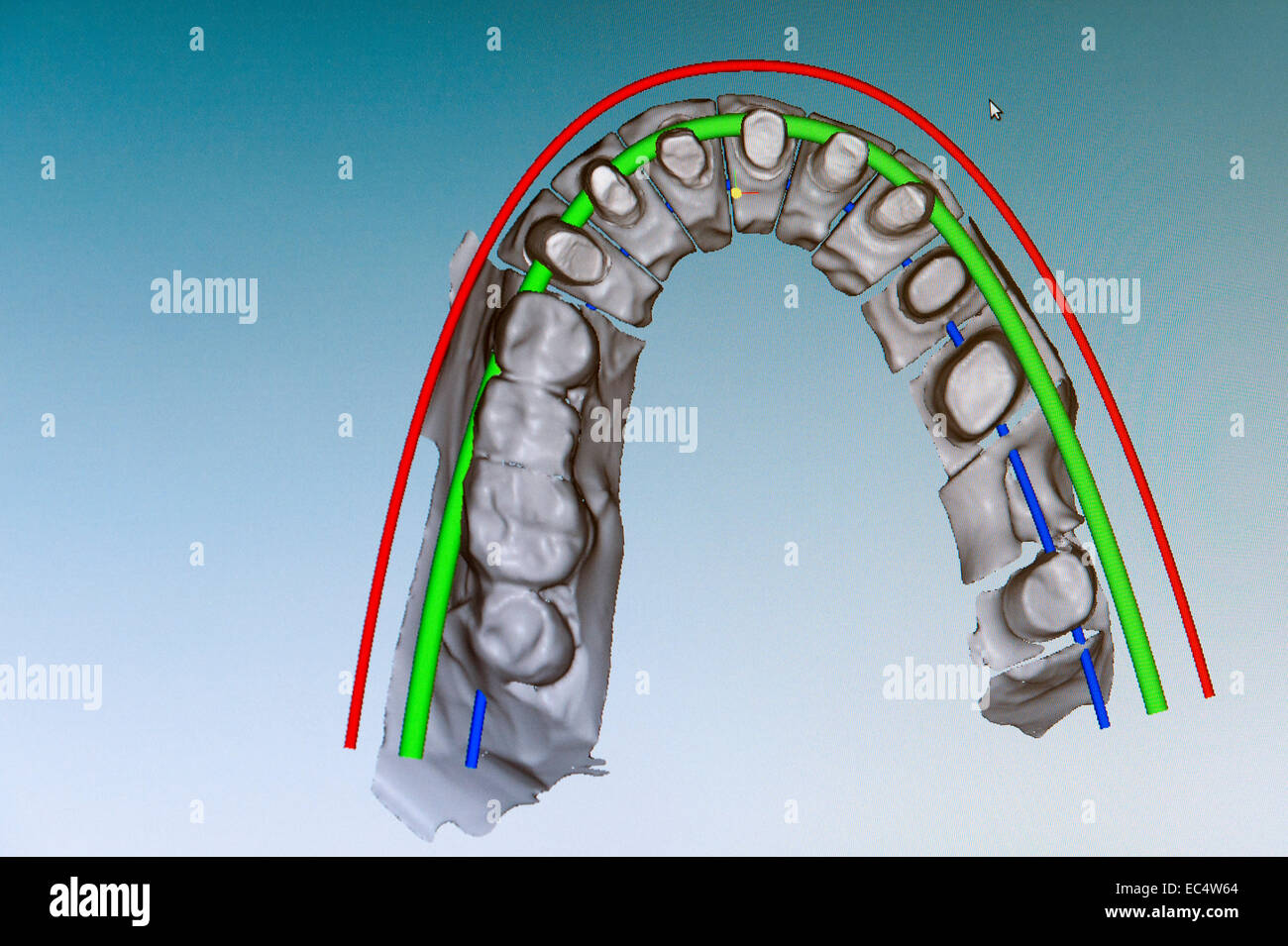Representation of the upper jaw model on the monitor Stock Photo - Alamy