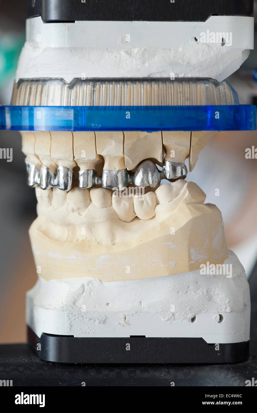 Teeth model frame with a crown in the articulator Stock Photo - Alamy
