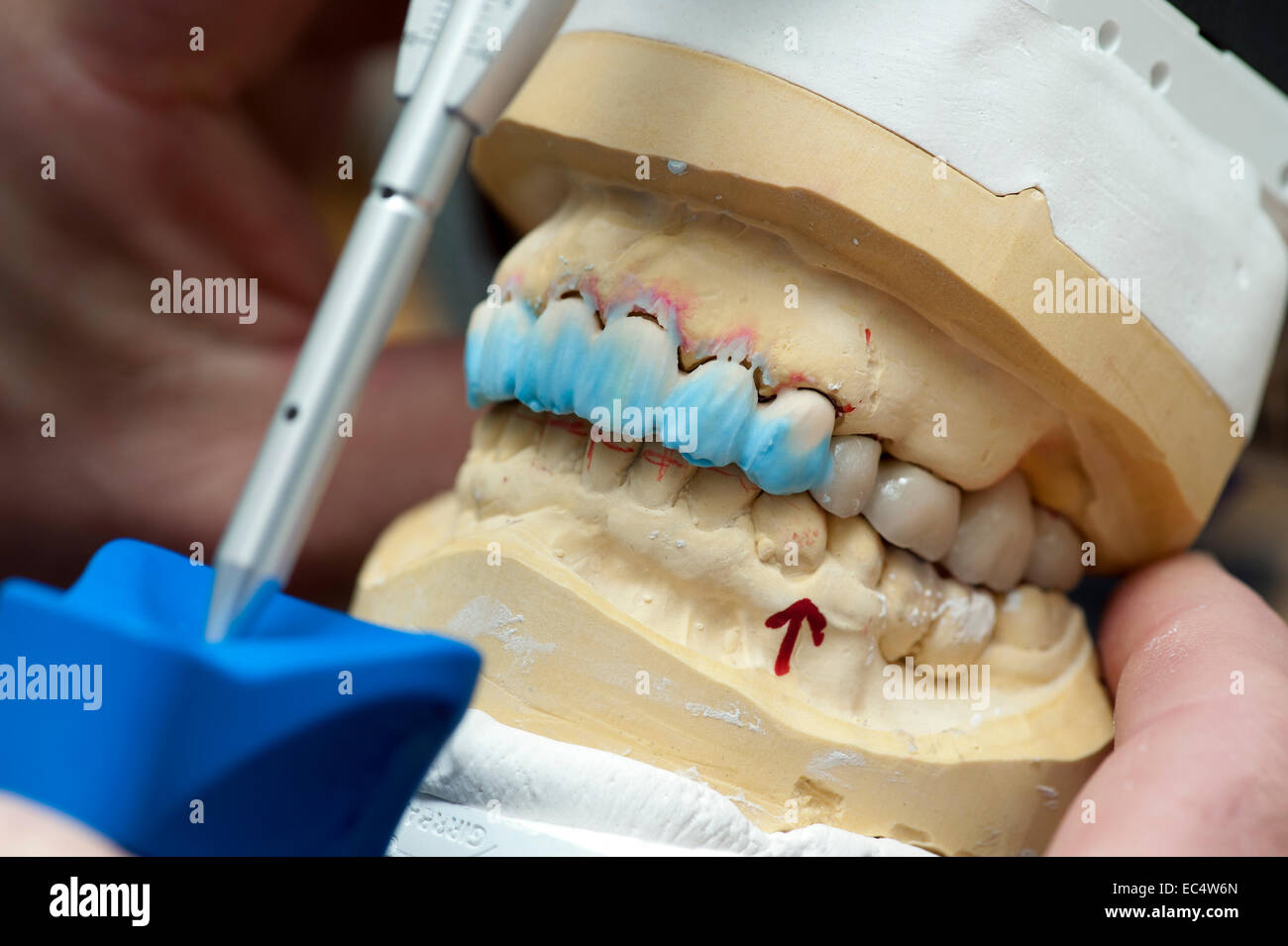 colored ceramic crowns in the upper model Stock Photo - Alamy