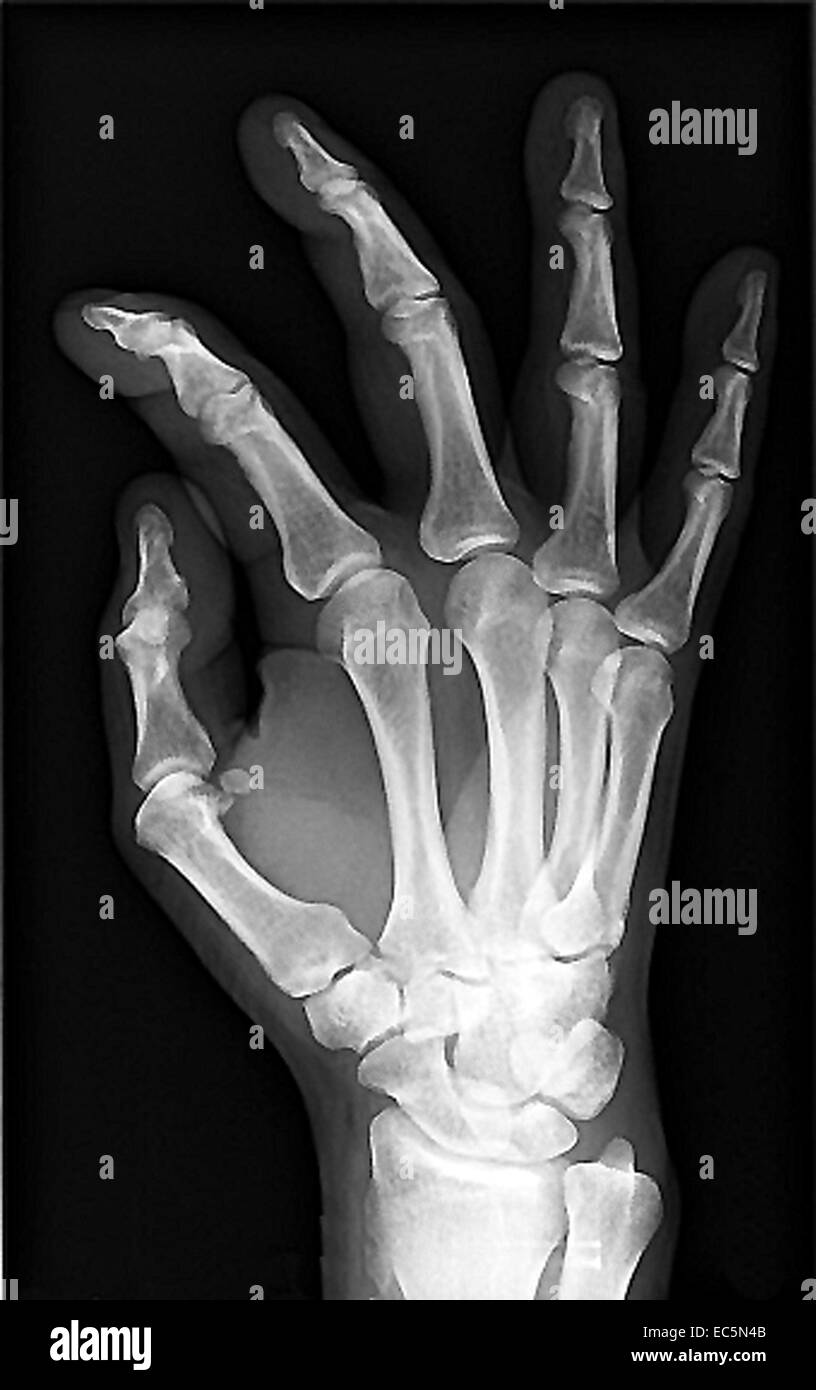 X Ray Hand Stock Photo - Alamy