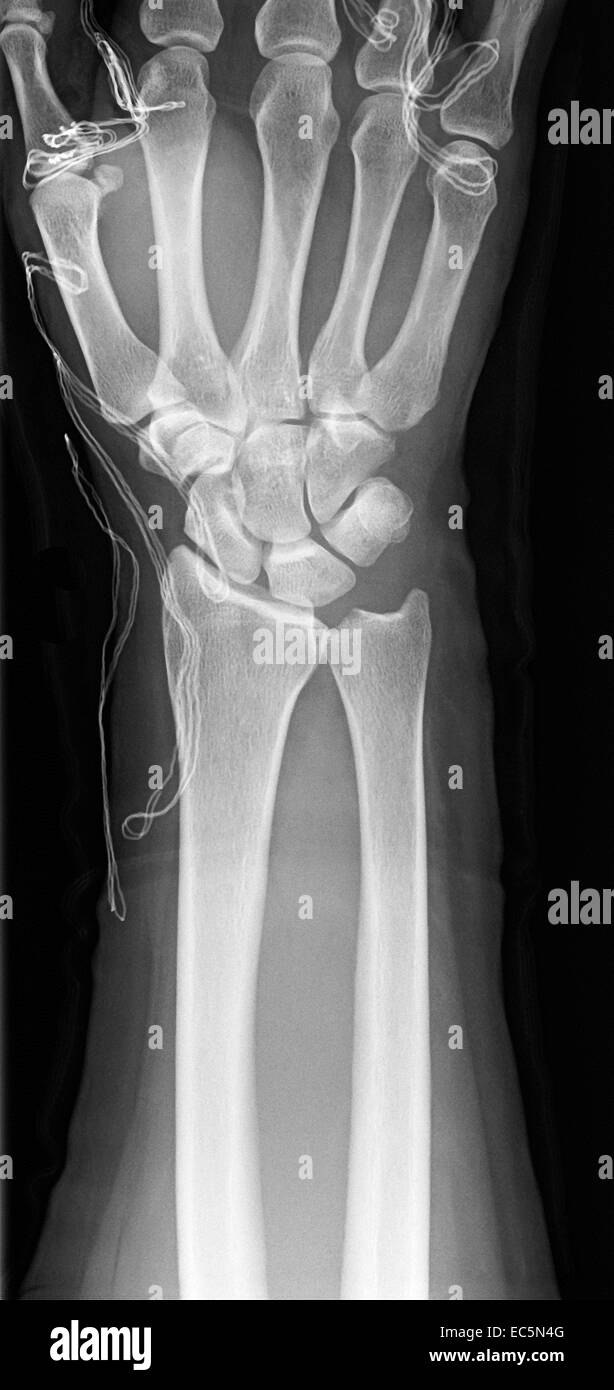 Gout hand hi-res stock photography and images - Alamy