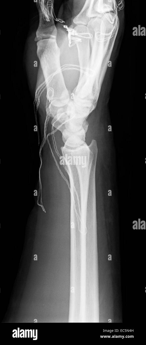 X Ray Hand Left Stock Photo - Alamy