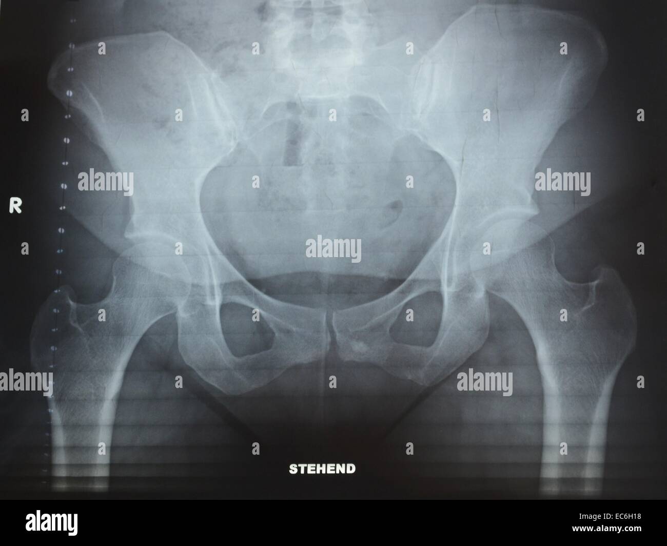 X ray pelvis hi-res stock photography and images - Alamy