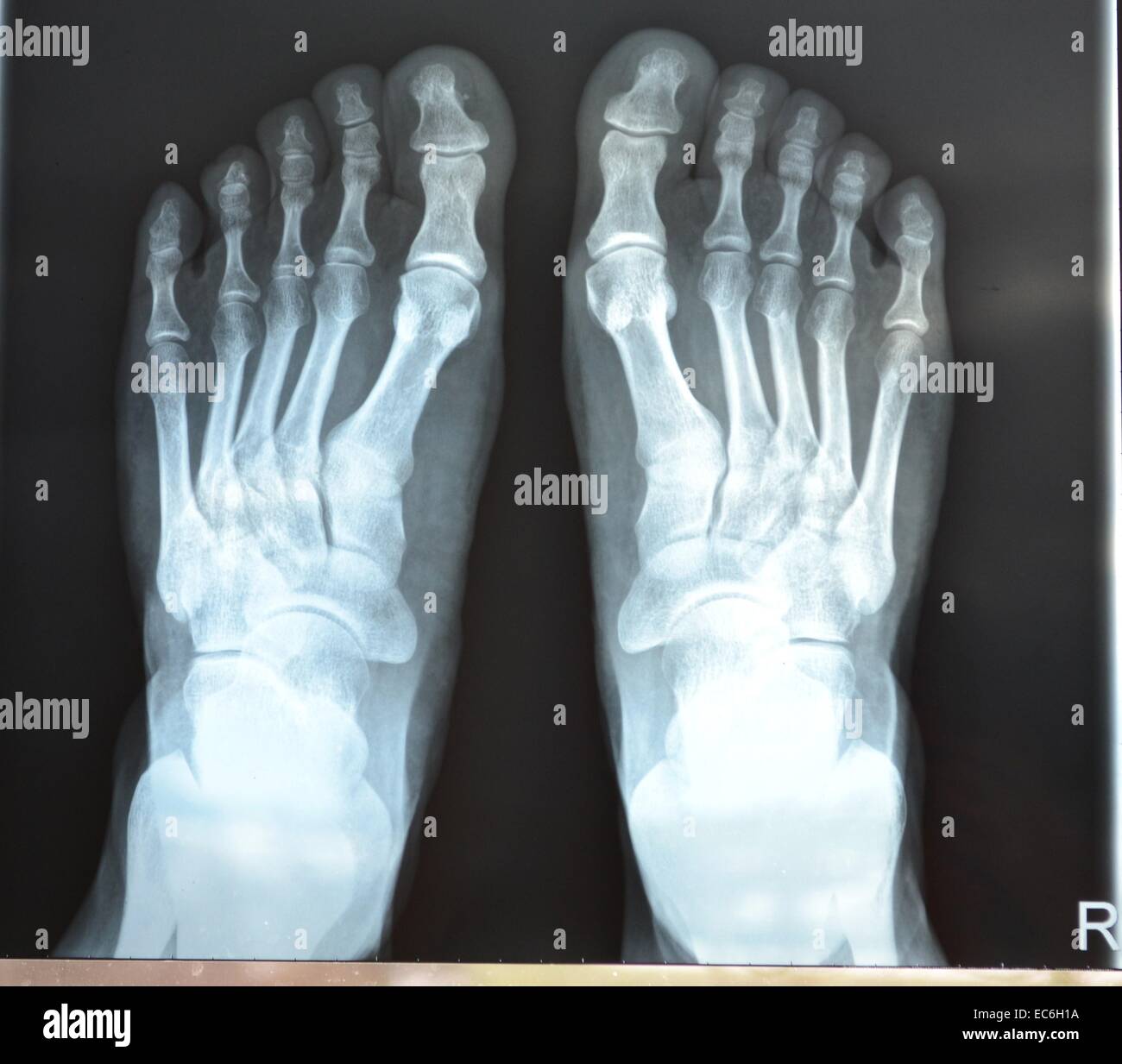 Radiograph Foot Stock Photos & Radiograph Foot Stock Images - Alamy