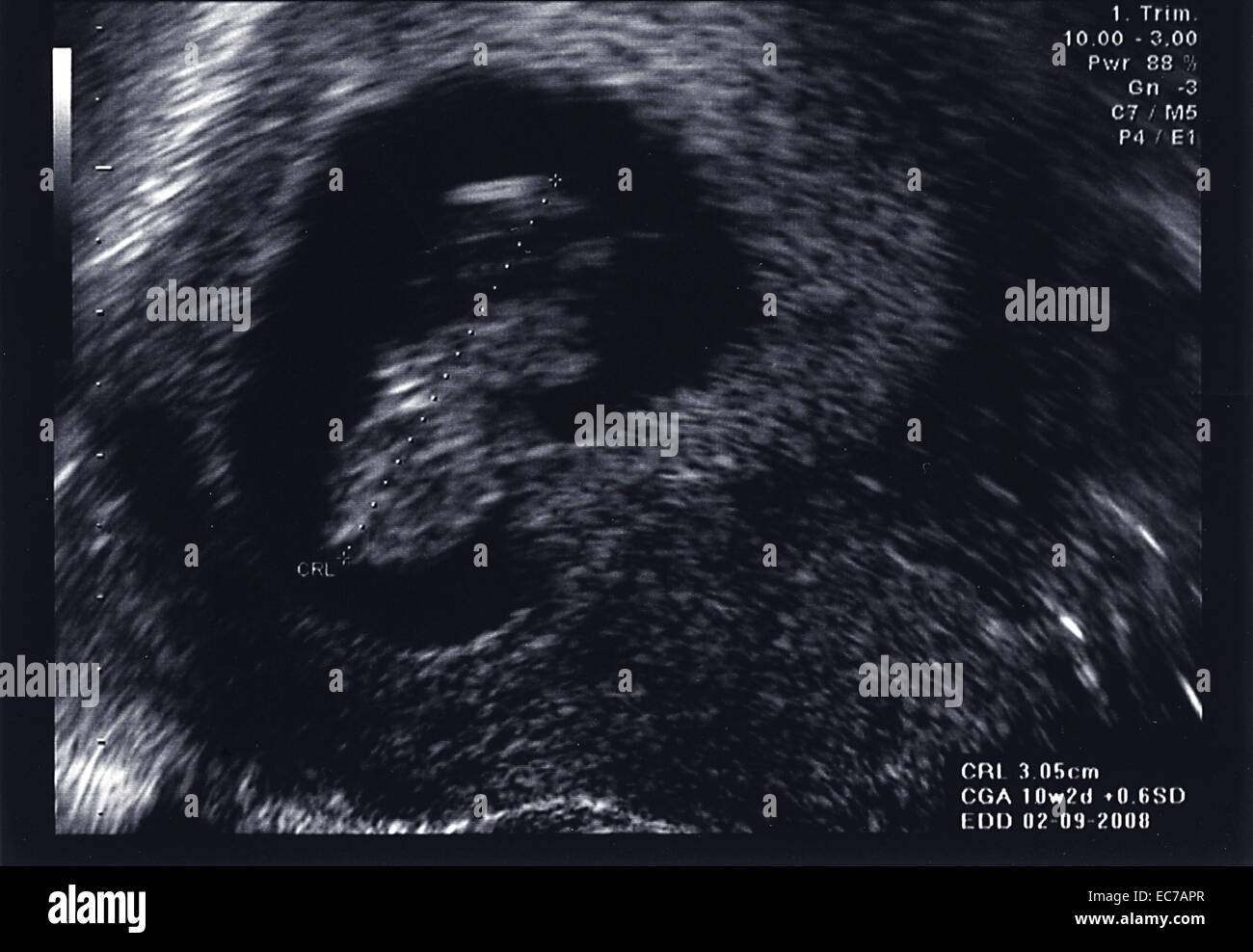 Ultrasound scan of fetus at first trimester Stock Photo - Alamy