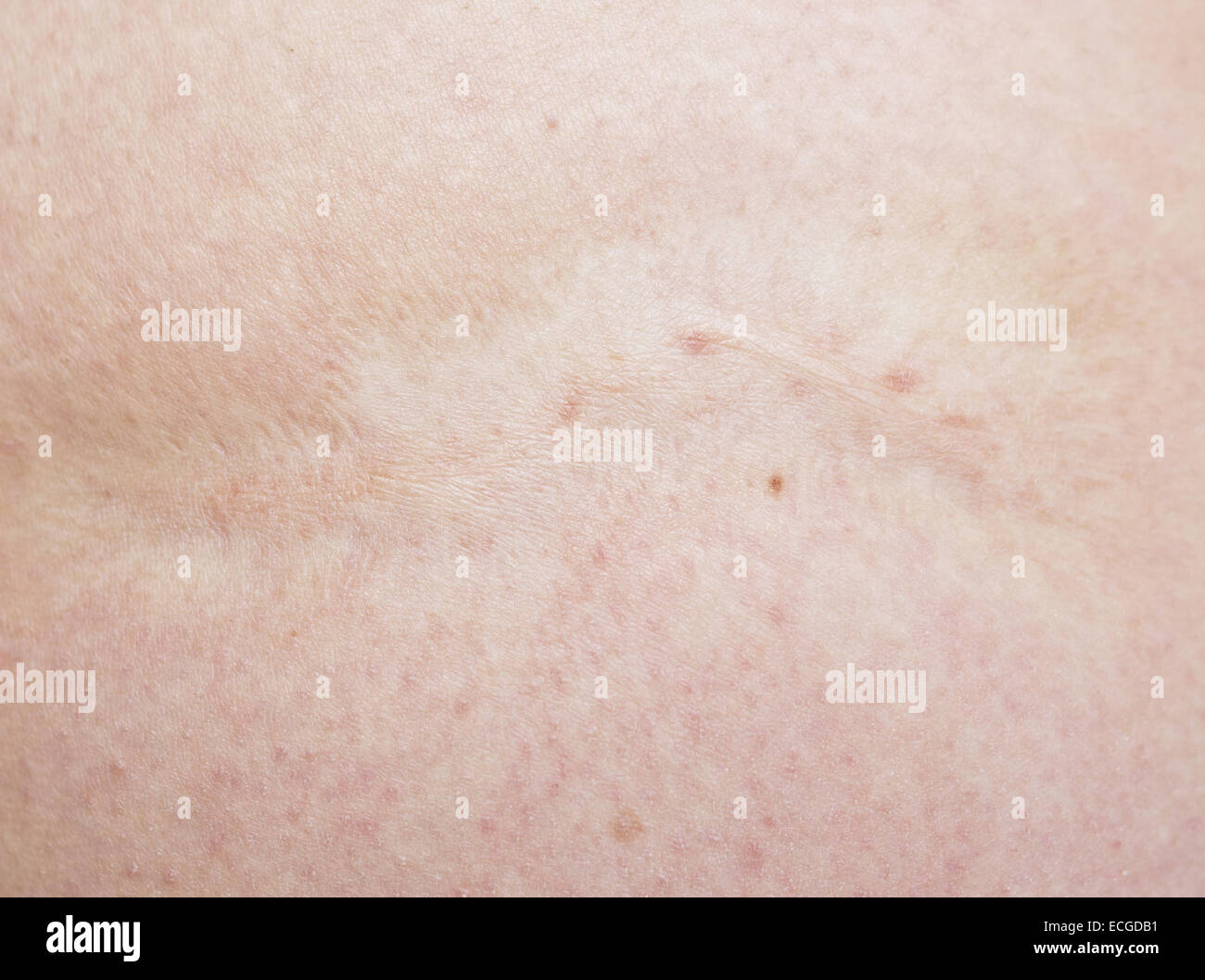 Burn Scar High Resolution Stock Photography and Images - Alamy