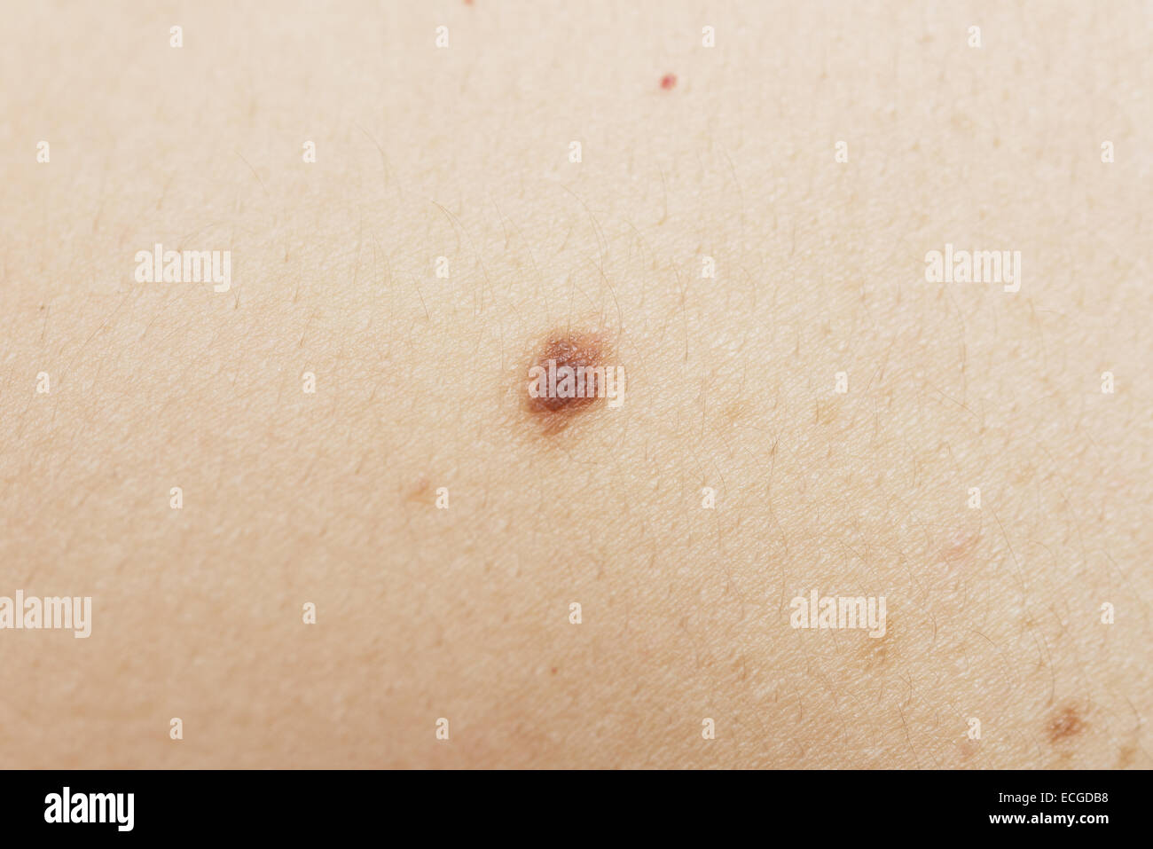 Close up skin pigmentation hi-res stock photography and images - Alamy