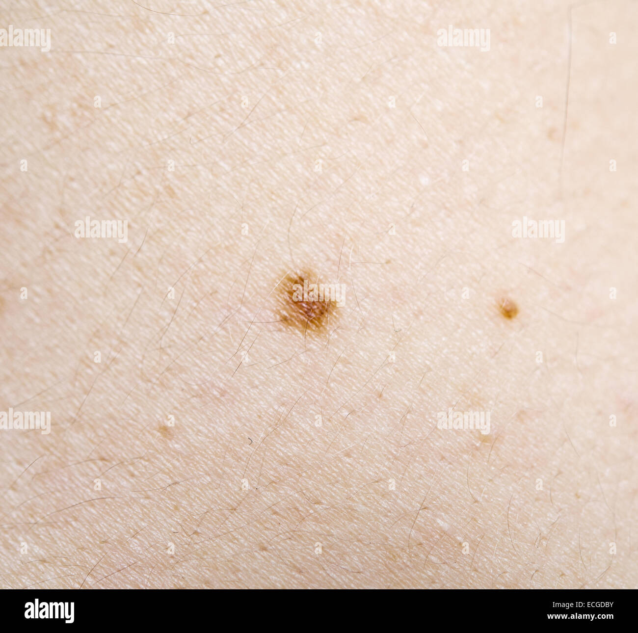 close up of mole on human skin Stock Photo - Alamy