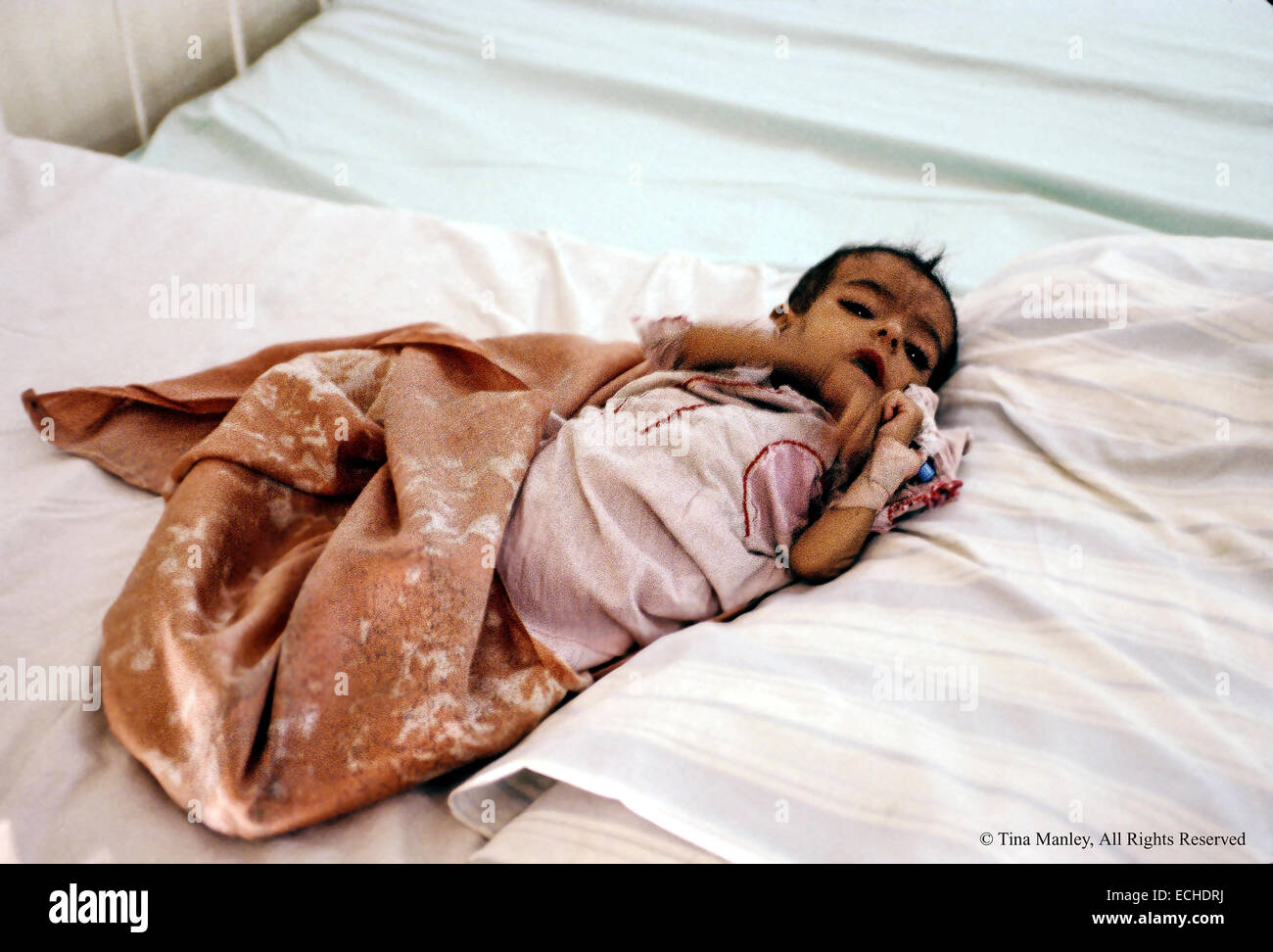 Malnourished and dehydrated baby in the Alwya Children's Hospital in ...