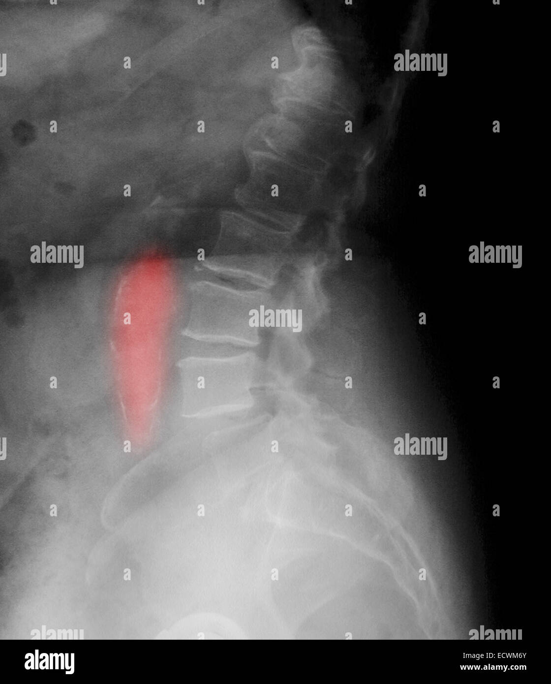 Abdomen x-ray showing aneurysm and calcification of aorta Stock Photo ...