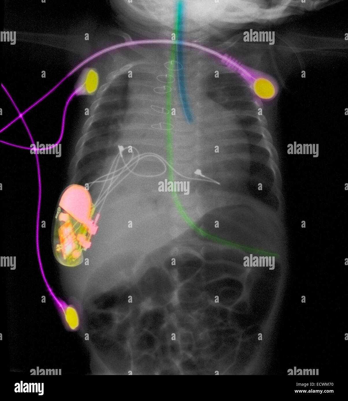 Chest x-ray of infant showing a pacemaker and cardiac monitor leads ...