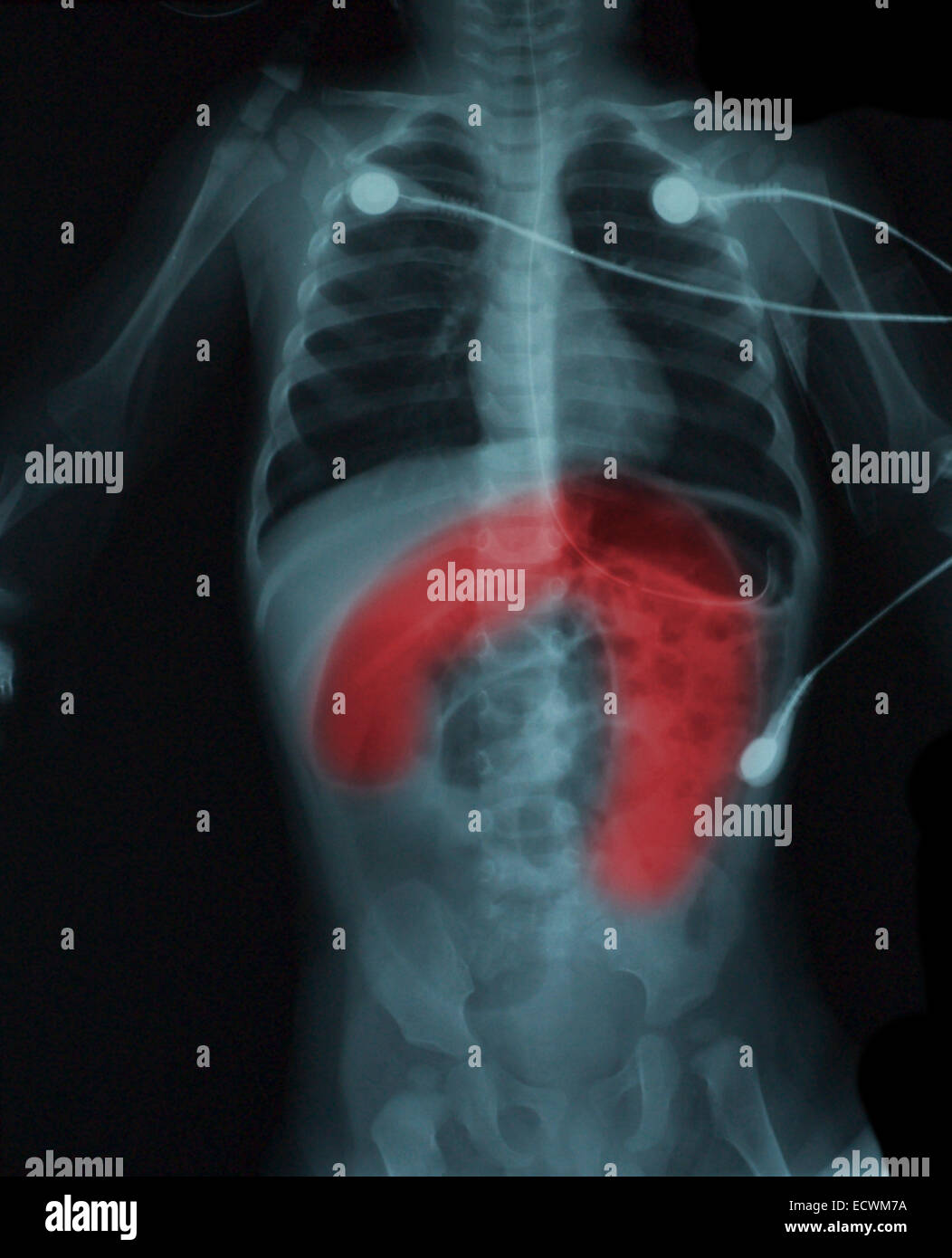 Infant x ray hi-res stock photography and images - Alamy