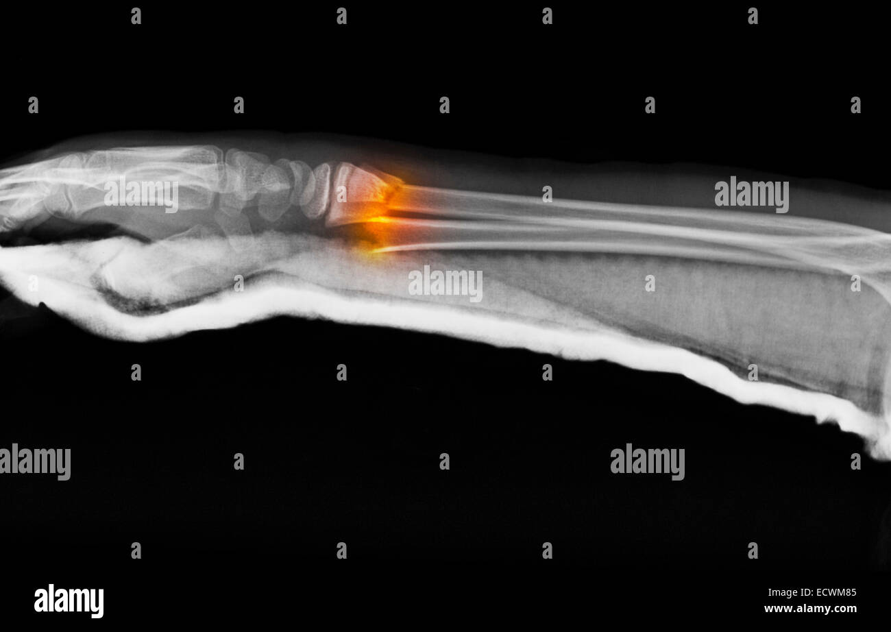 Forearm bone fracture hi-res stock photography and images - Alamy
