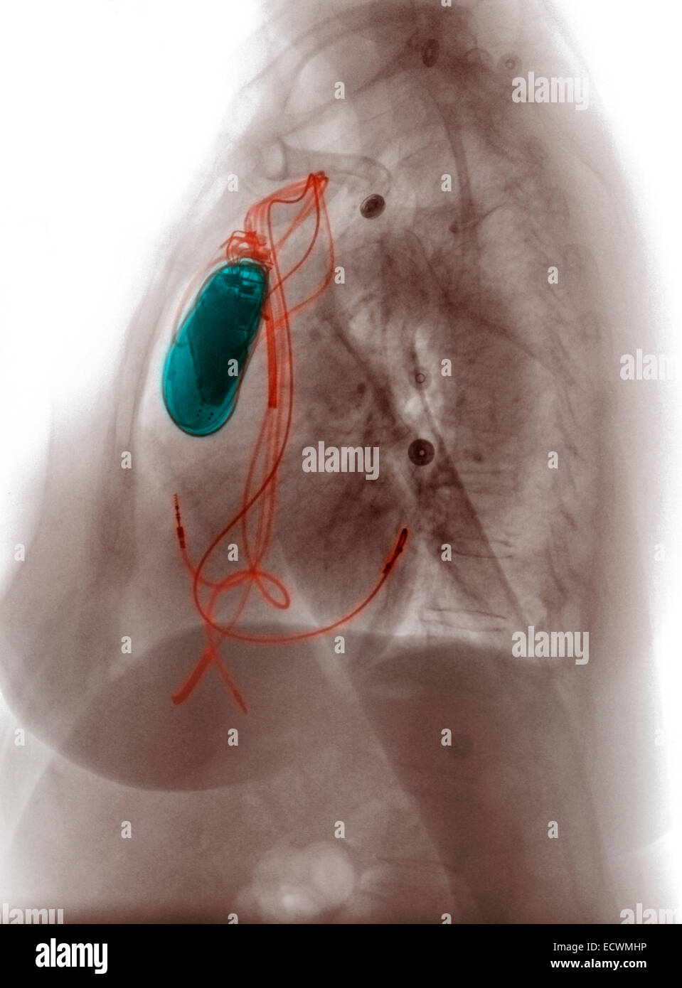 Heart Pacemaker X Ray High Resolution Stock Photography and Images - Alamy