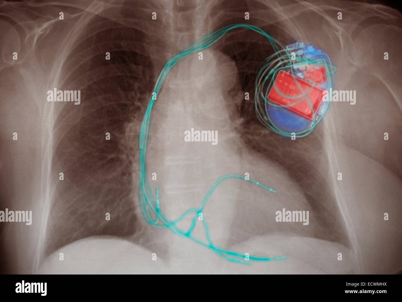 The pacemaker hi-res stock photography and images - Alamy