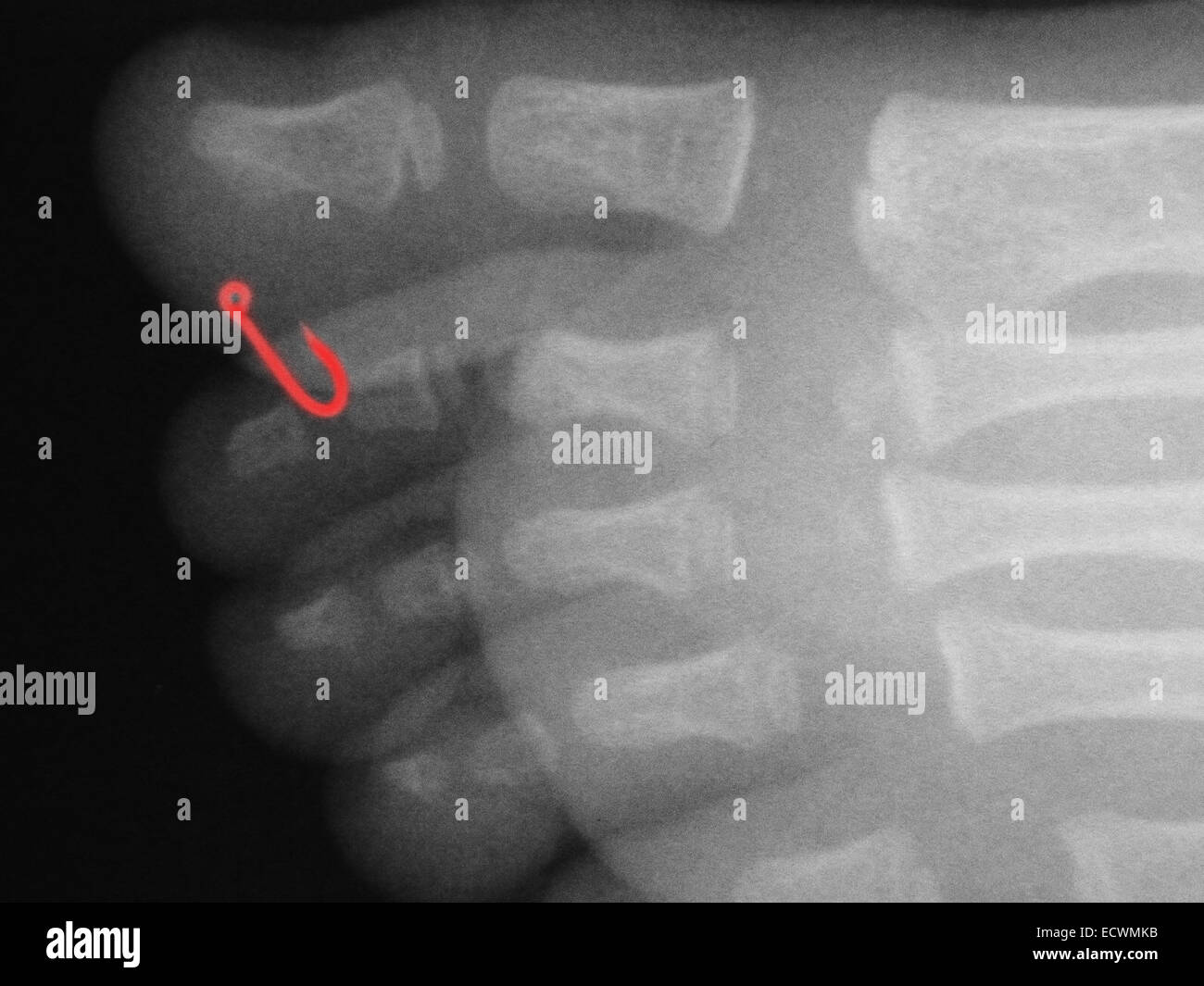 X-ray of the foot with a fishhook in the toe Stock Photo - Alamy