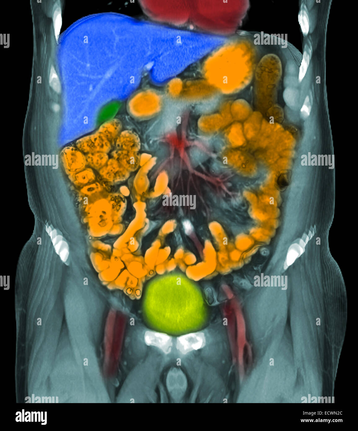 Coronal reconstructions ct scan abdomen hi-res stock photography and ... Coronal reconstructions ct scan abdomen hi-res stock photography and ...