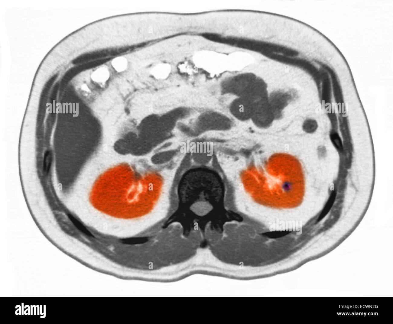 Ct Scan Showing Kidney Stones