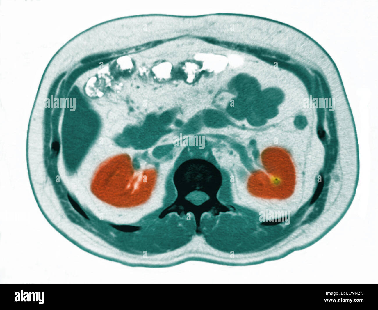 CT scan of the abdomen showing a small kidney stone Stock Photo - Alamy