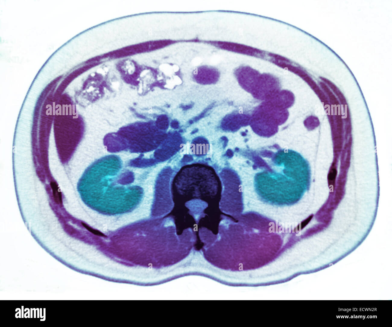 CT scan of the abdomen showing a small kidney stone Stock Photo - Alamy