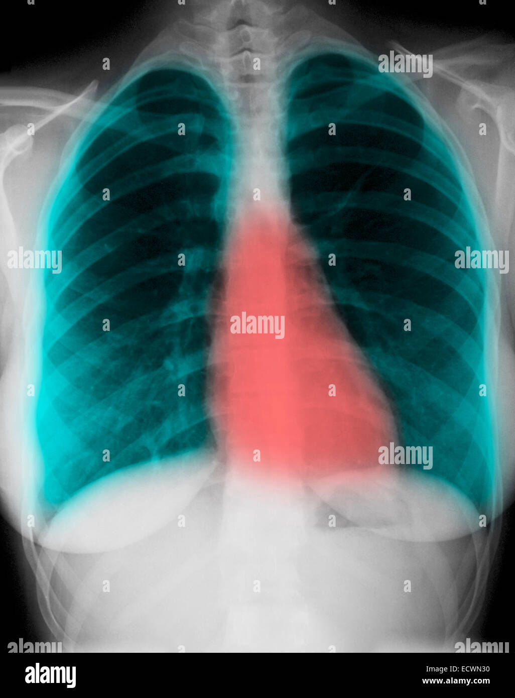 Lungradiology hi-res stock photography and images - Alamy