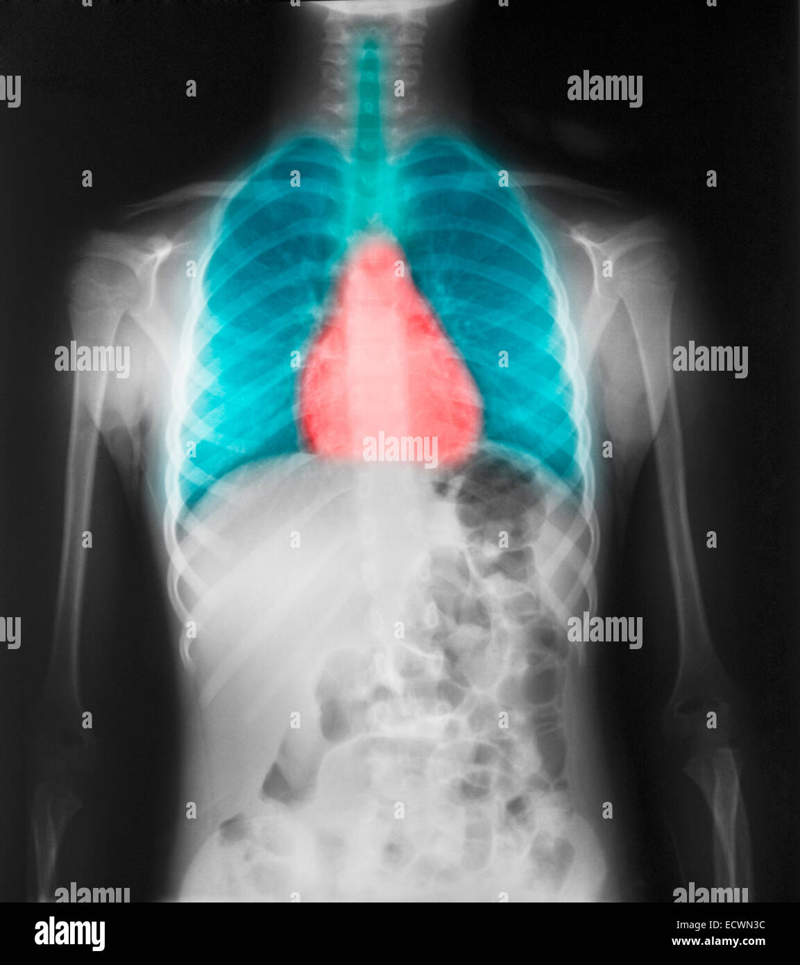 Normal chest x-ray of a 7 year 10 month old female Stock Photo - Alamy