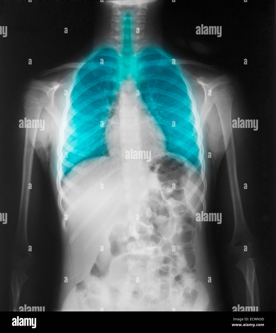 Normal Chest X Ray Female