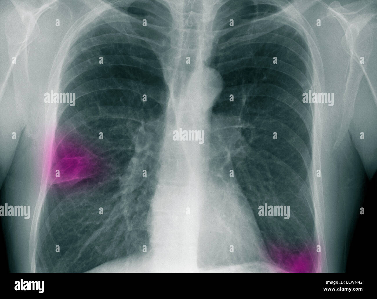 Chest X Ray Infiltrates