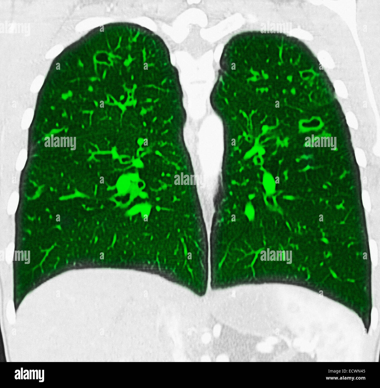 Cystic fibrosis CT scan coronal view Stock Photo - Alamy
