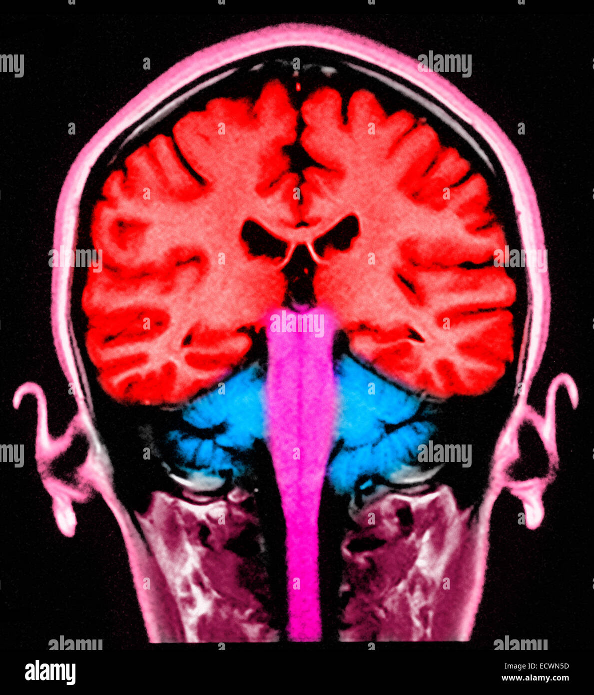 Skull brain cross section hi-res stock photography and images - Alamy