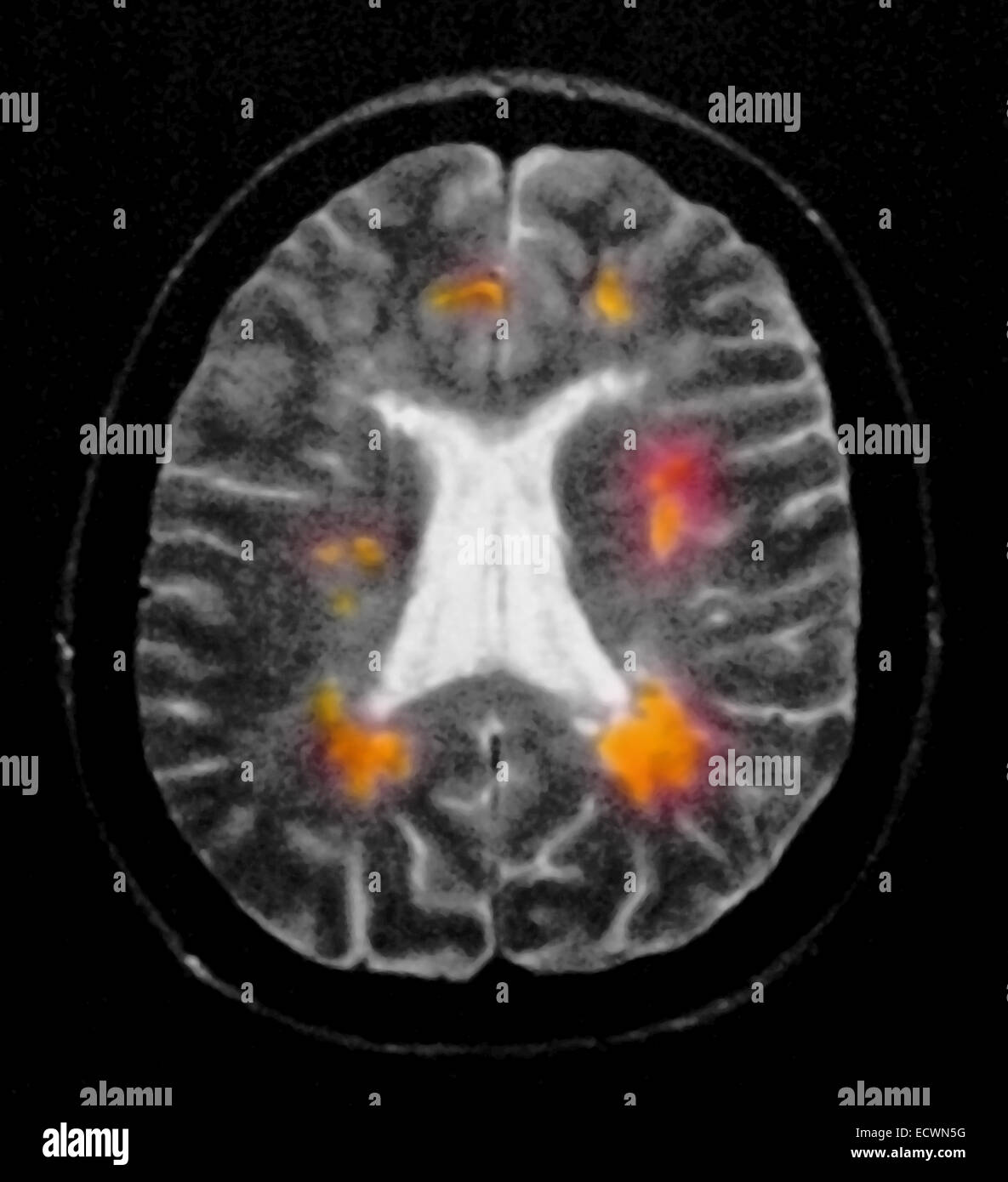 Brain MRI showing multiple sclerosis. 36 year old female Stock Photo ...