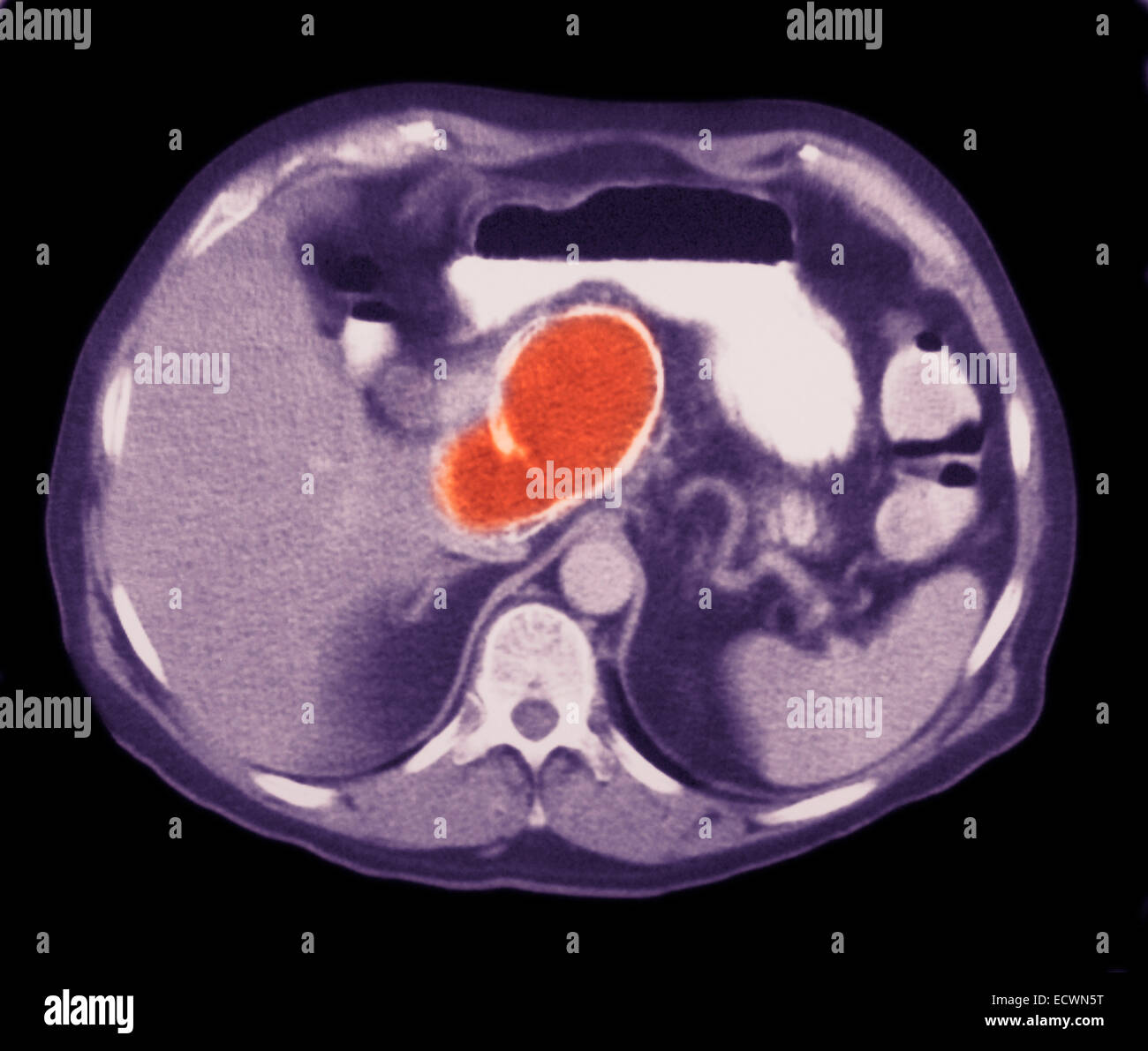 Cross section of pancreas hi-res stock photography and images - Alamy