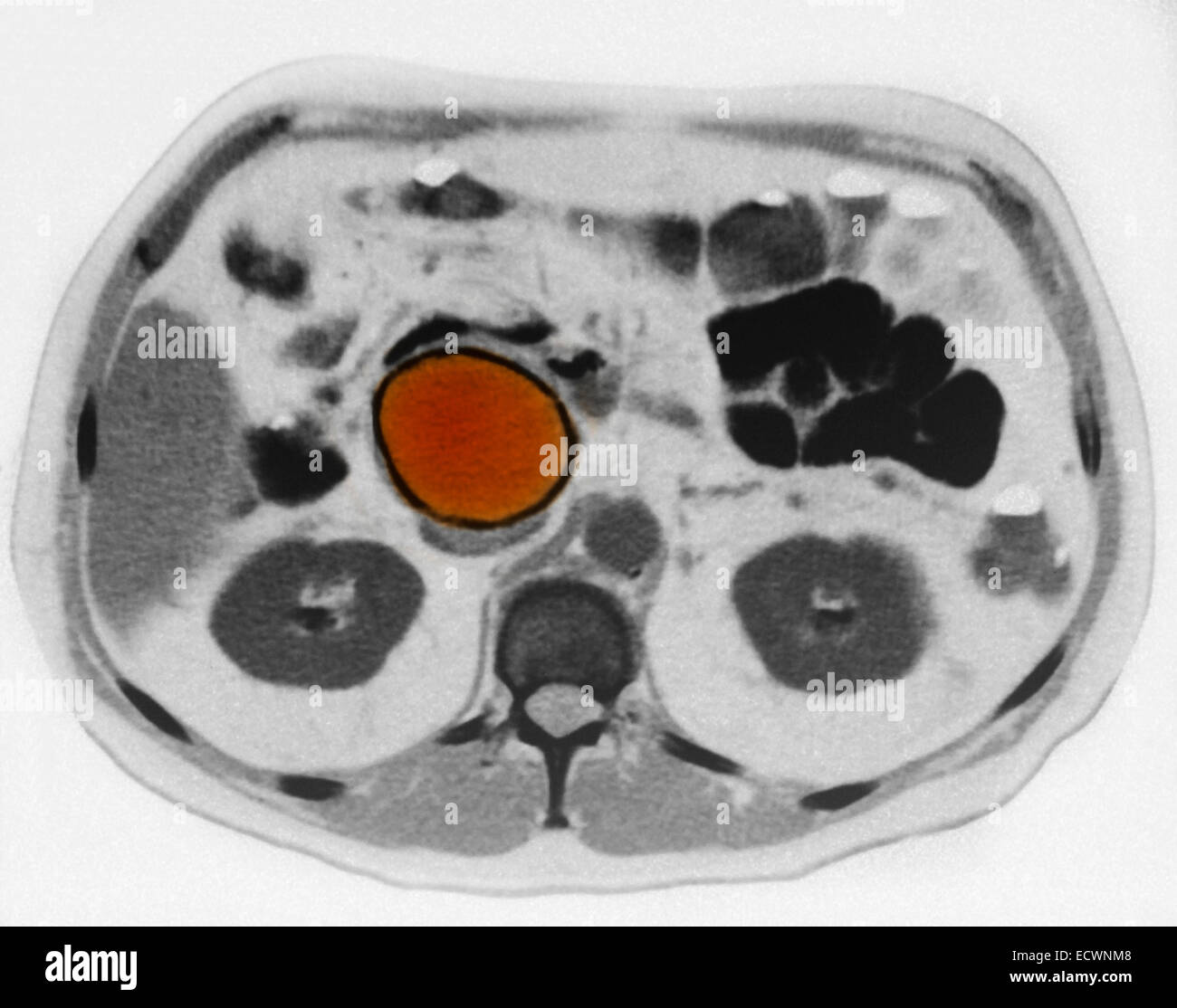 Pancreatic pseudocyst seen on MRI Stock Photo - Alamy
