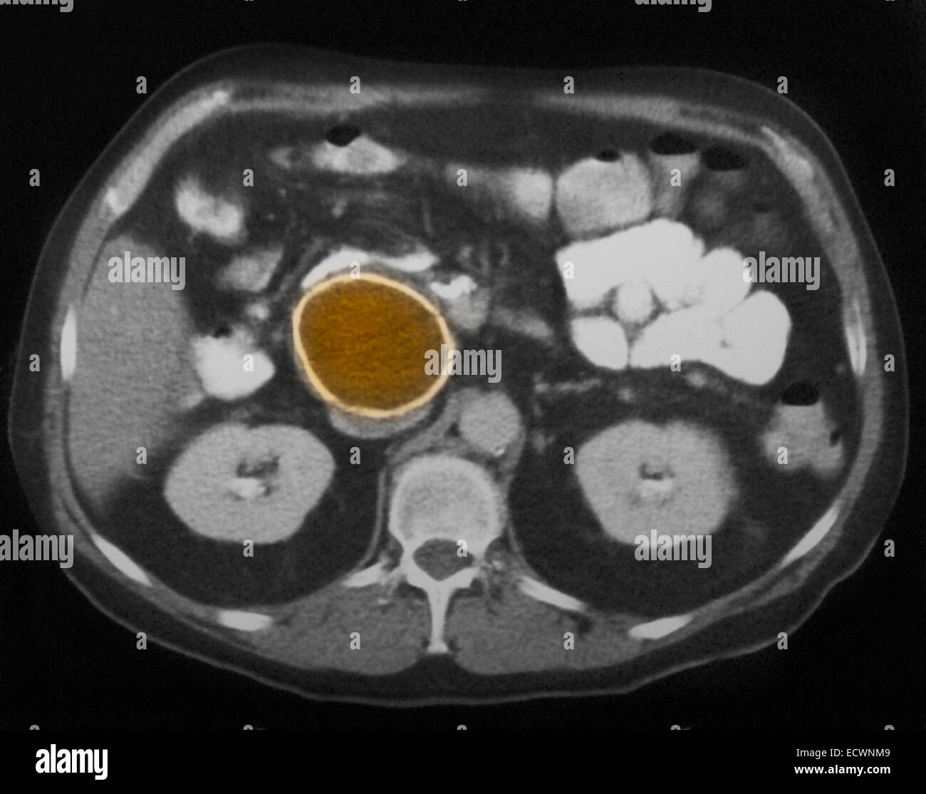 Cross section of pancreas hi-res stock photography and images - Alamy