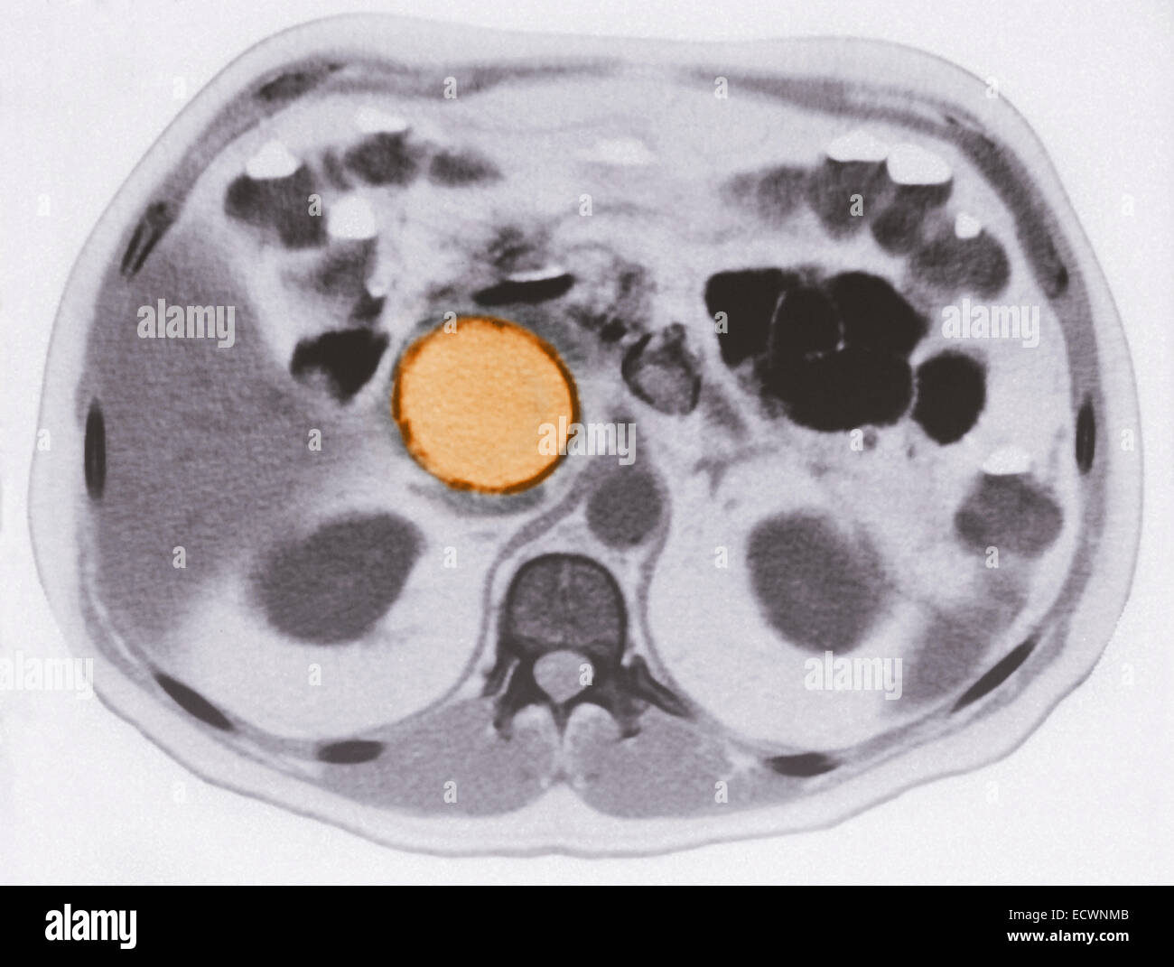 Pancreatic pseudocyst seen on MRI Stock Photo - Alamy