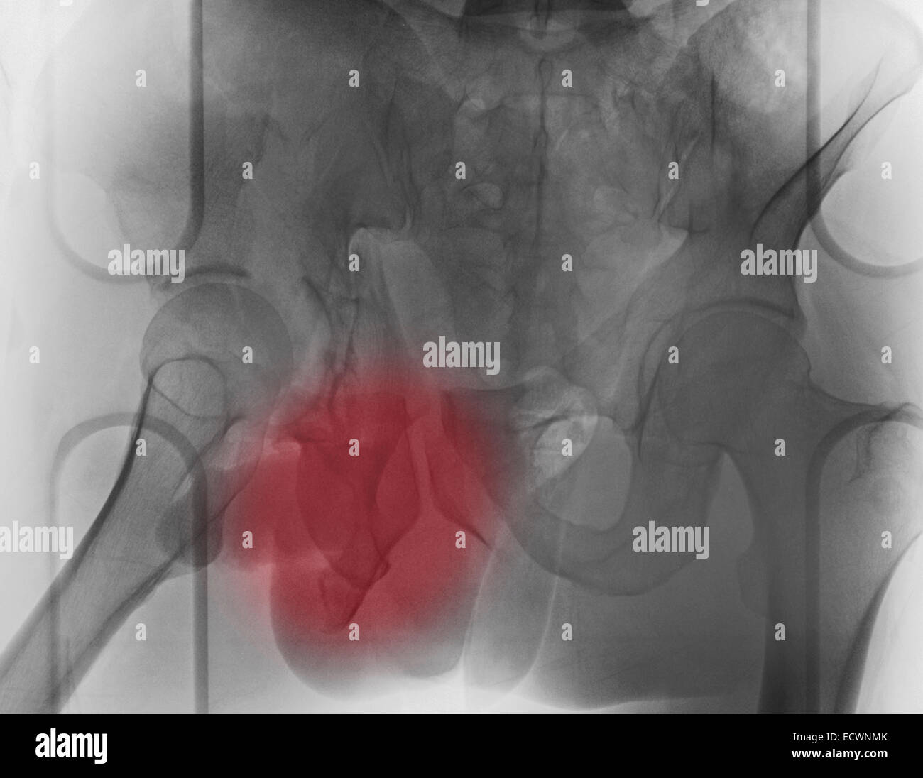 X-ray of a 30 year old man with a pelvic fracture Stock Photo - Alamy