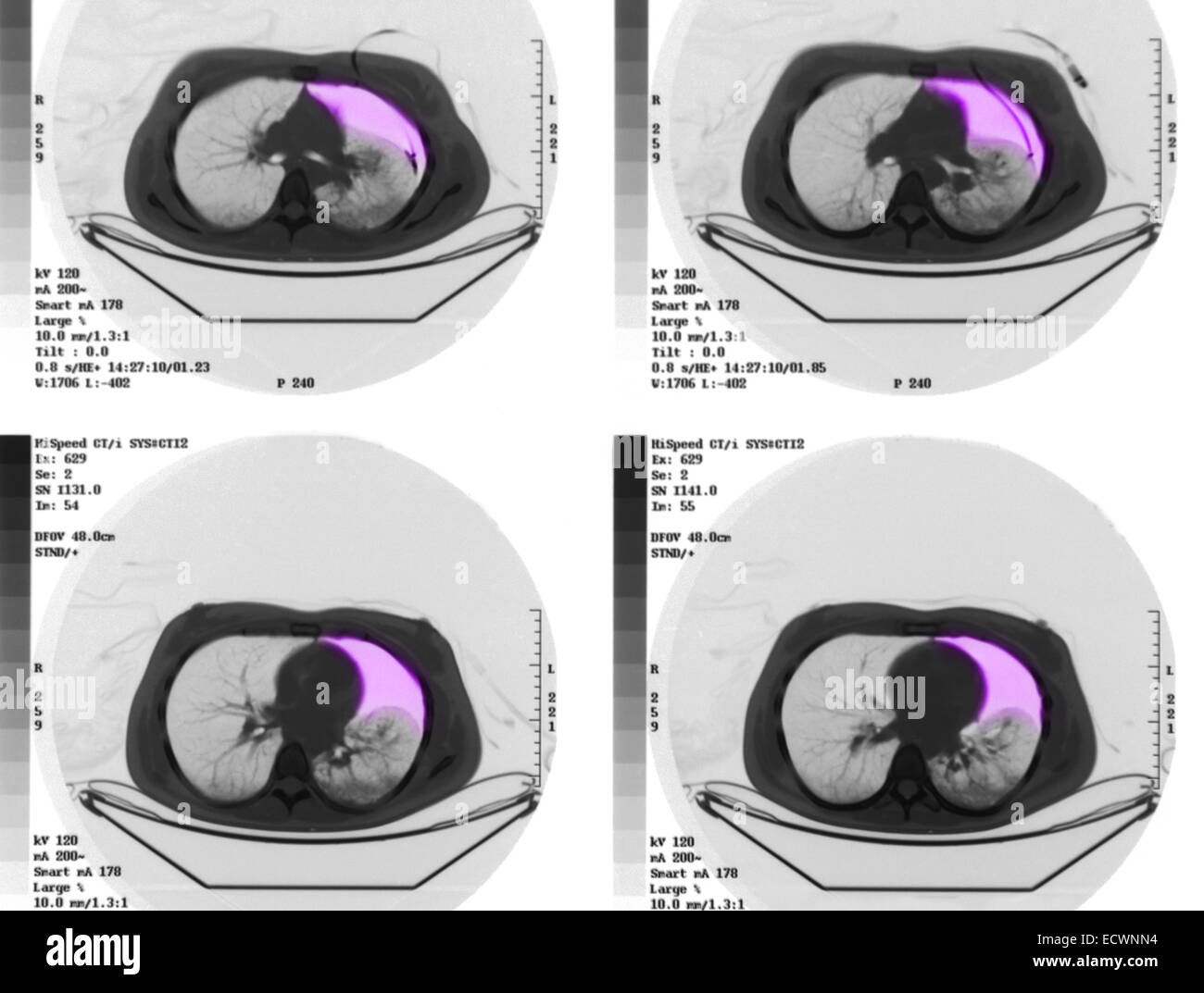 Chest x-ray showing spontaneous pneumothorax Stock Photo - Alamy Chest x-ray showing spontaneous pneumothorax Stock Photo - Alamy