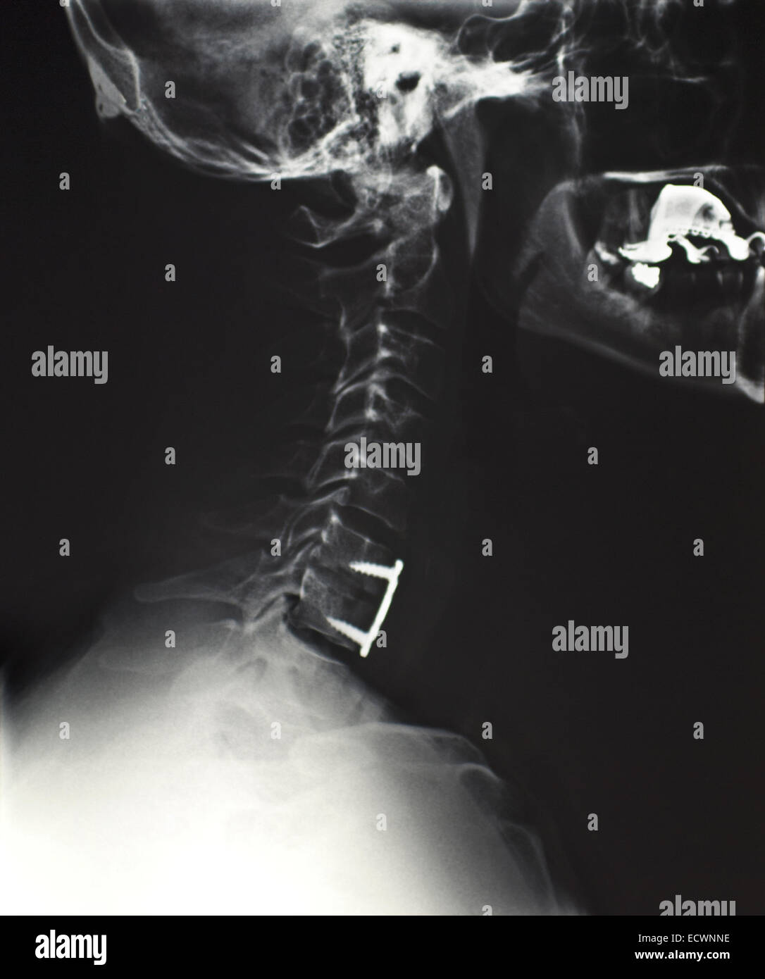X ray of spinal fusion hi-res stock photography and images - Alamy
