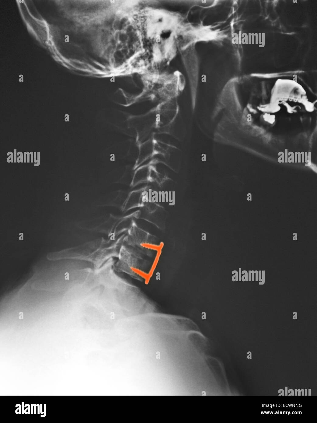 X ray of spinal fusion hi-res stock photography and images - Alamy