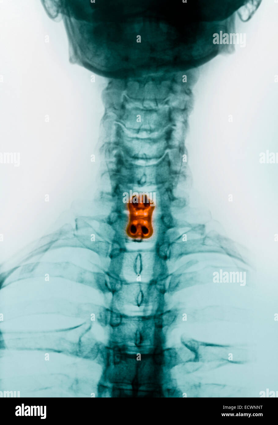 cervical neck x-ray showing spinal fusion Stock Photo - Alamy