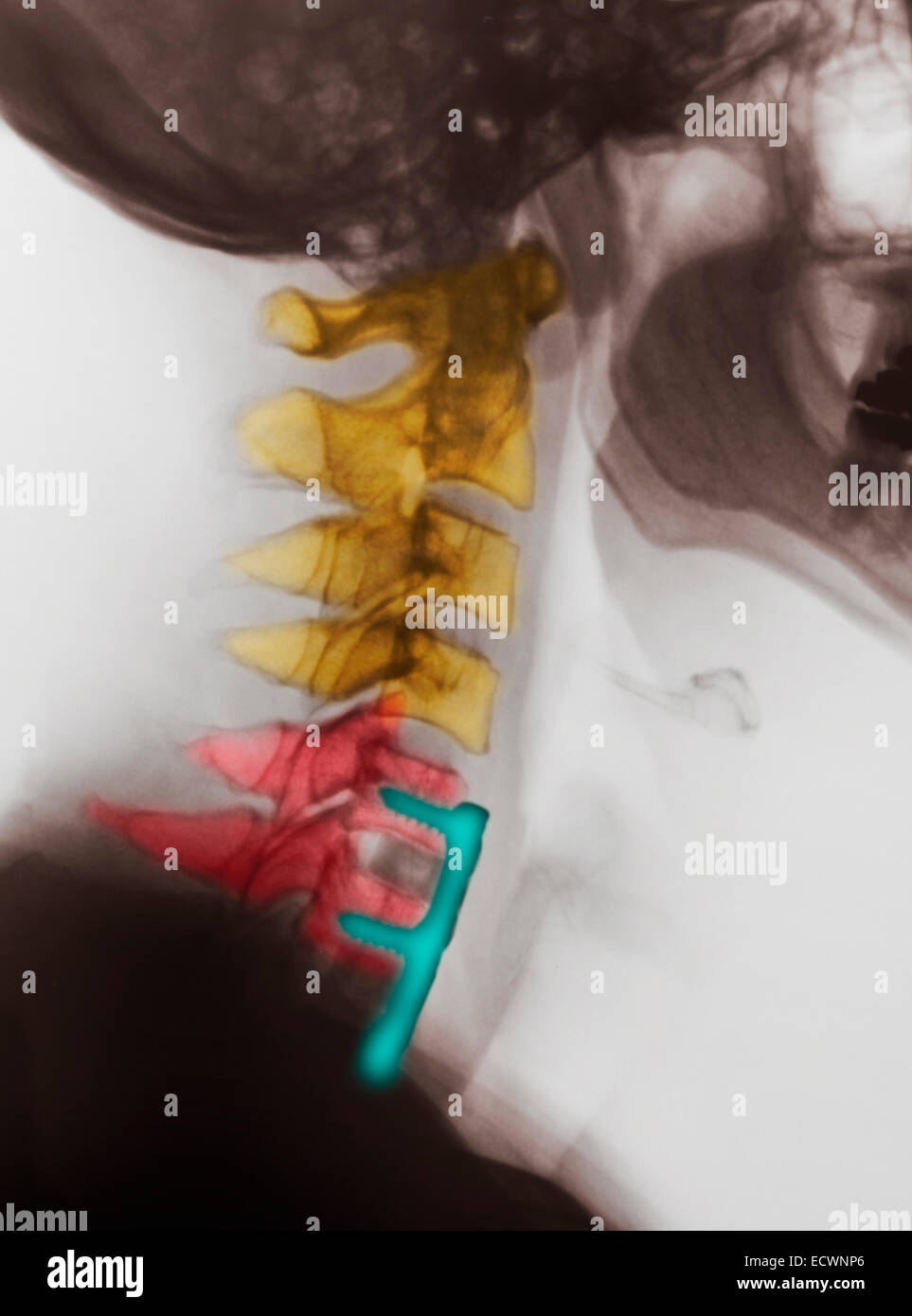 cervical neck x-ray showing spinal fusion Stock Photo - Alamy